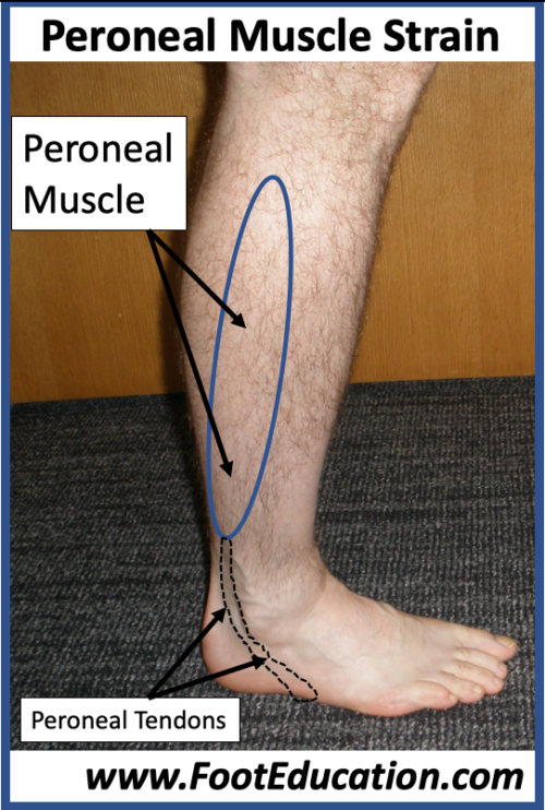 Peroneal Muscle Strain FootEducation Peroneal Muscle Strain FootEducation