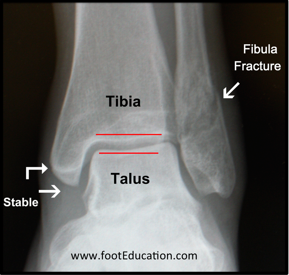 Ankle Fracture - FootEducation