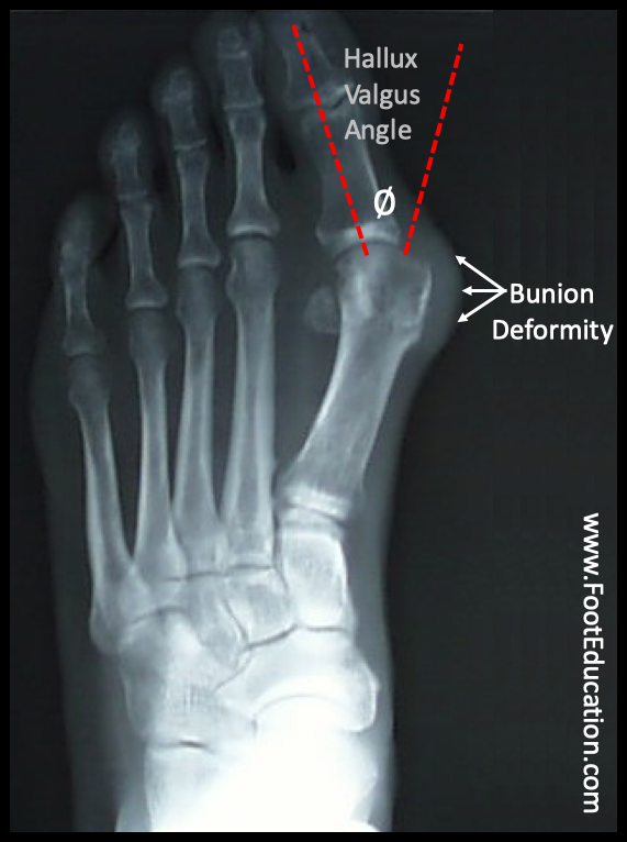 Bunions - FootEducation