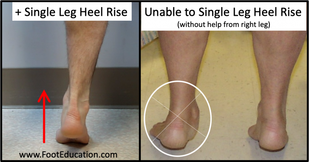 Acquired Adult Flatfoot Deformity - FootEducation