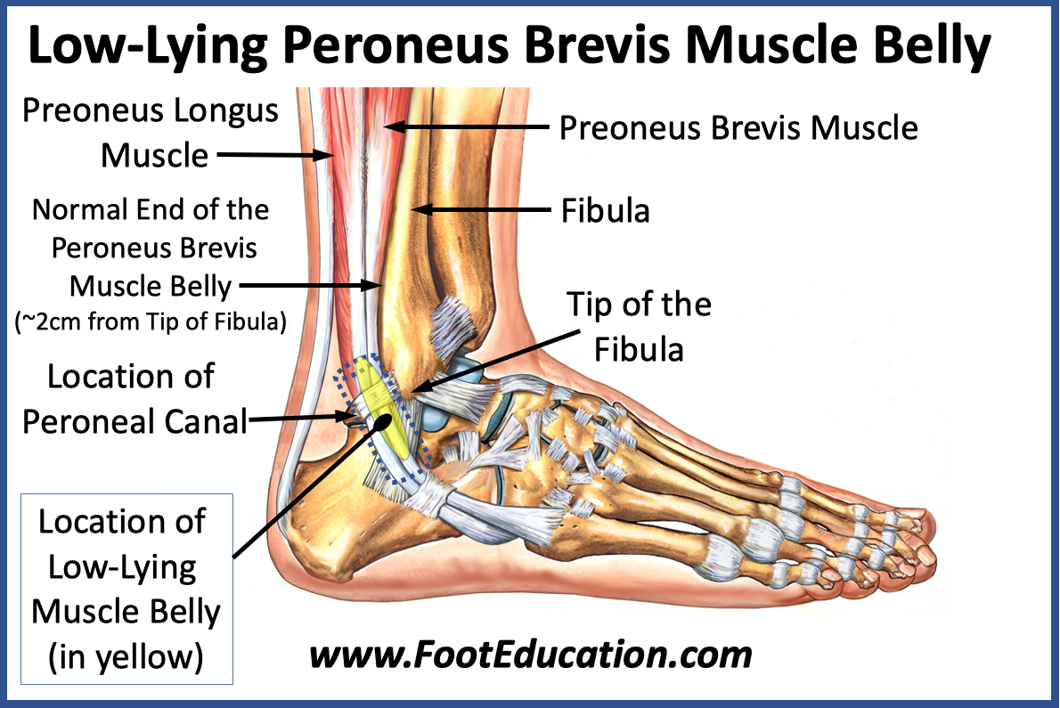 Low-Lying Peroneus Brevis Muscle Belly - Peroneus Quartus Muscle ...